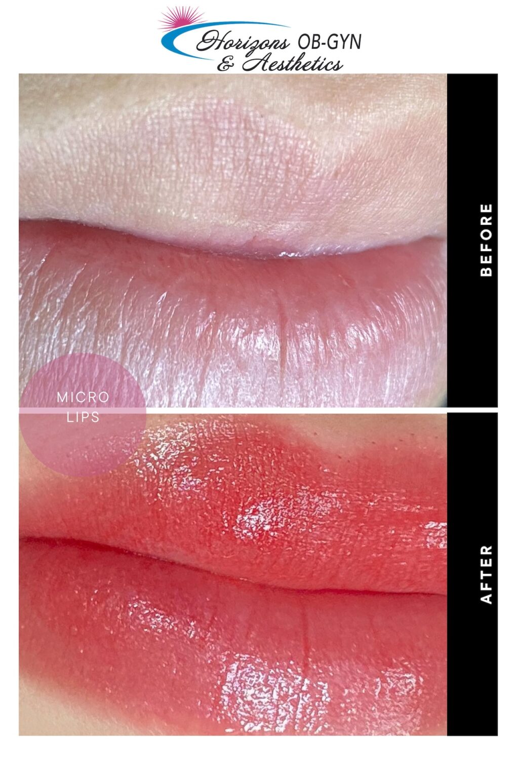 Micro Lips 4 - Horizons OBGYN
